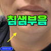 턱밑 통증 턱아래 멍울 침샘염증상 원인치료 병원 네이버 블로그